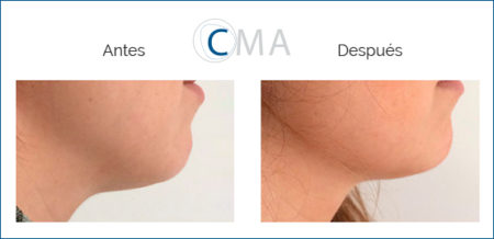 Guía de tratamientos para la Papada - Cuello - Clínicas Mato Ansorena